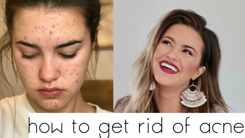 How I Cleared My Skin Permanently/ Accutane | Alyssa Mikesell - Yandex ...
