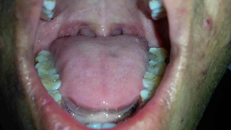 Tongue Fasciculation in MND - Смотреть онлайн в поиске Яндекса по Видео