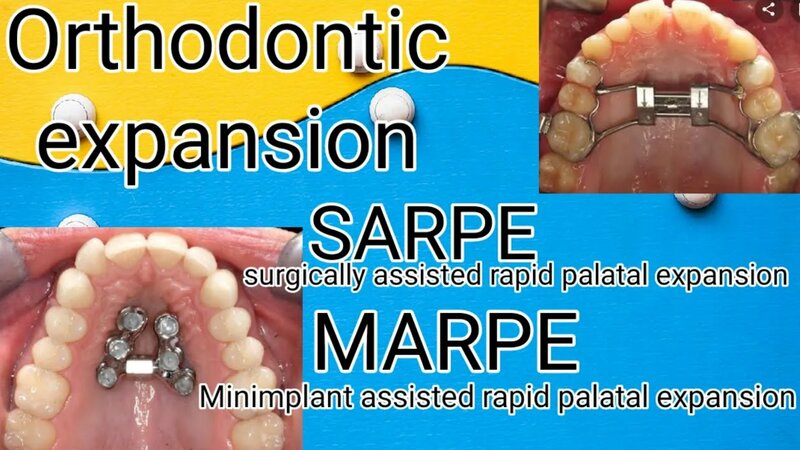 Orthodontic Challenges with conventional Expansion, Sarpe and Marpe ...