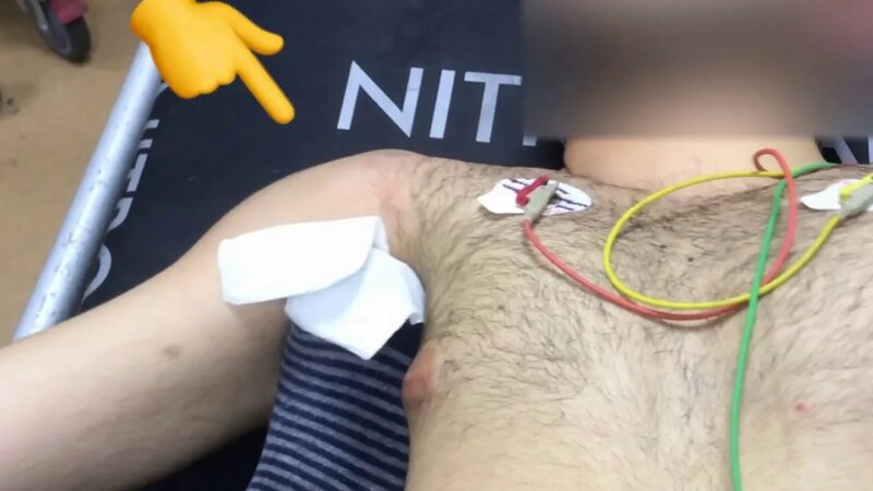 Hipokrat Yöntemiyle Omuz Redüksiyonu/Hippocratic Method Of Reducing ...