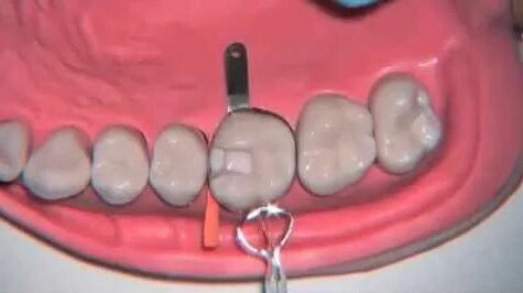 Posterior Dental Matrix: MetaFix Application Demo (EN) - Yandex Video ...