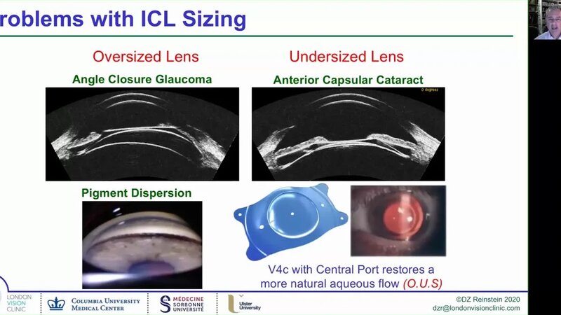 Implantable Collamer Lens (ICL) - from basics to advanced sizing ...