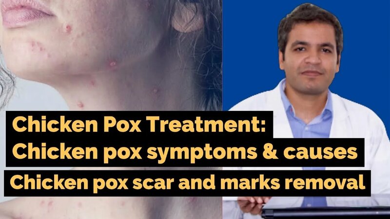 Chicken pox treatment: Chicken pox symptoms & causes | Chicken pox scar ...