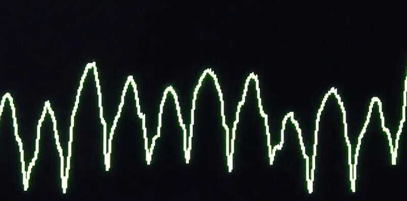 Cardiac arrest rhythms, VF, VT, Asystole and PEA - Yandex Video aramada ...