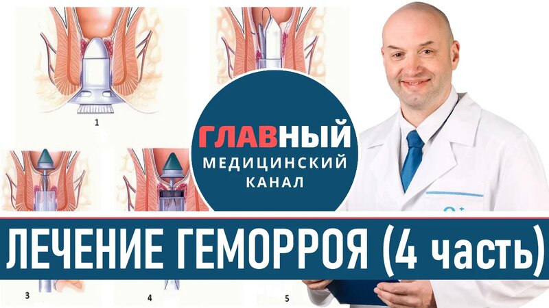 Лечение геморроя (4). Операция HAL-RAR. Как эффективно вылечить ...