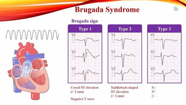 Brugada Syndrome - Pathophysiology, Diagnostic criteria and Management ...