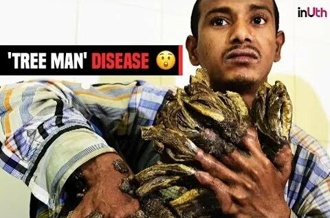 Meet the man whose disease turned him into a tree | Tree man syndrome ...