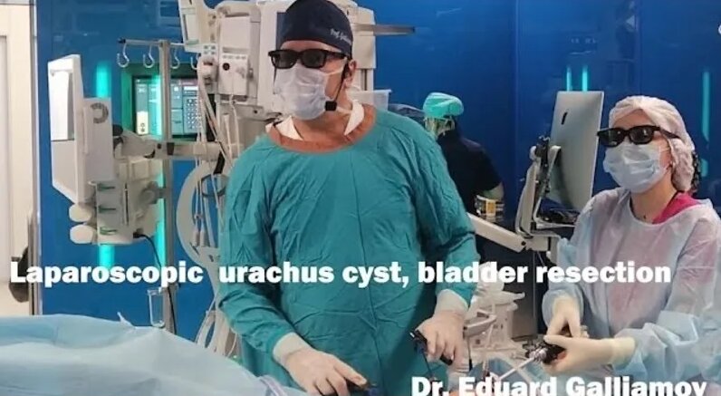 Киста урахуса с резекцией мочевого пузыря / Laparoscopic urachus cyst ...