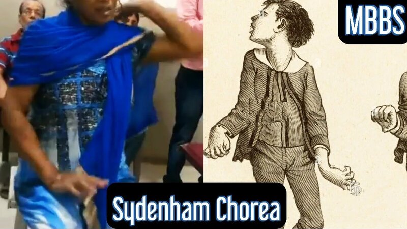 Sydenham Chorea or St Vitus Dance- Basal Ganglia Disorder #mbbs # ...