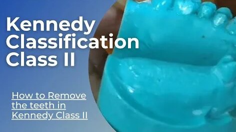 Kennedy classification Class 2| Kennedy Classification| Kennedy ...