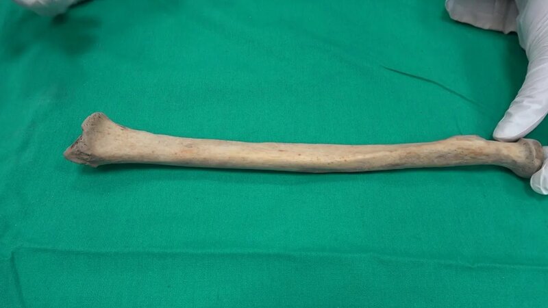 Anatomi Kemikler-Üst Ekstremite Kemikleri- Os Radius Anatomisi ...