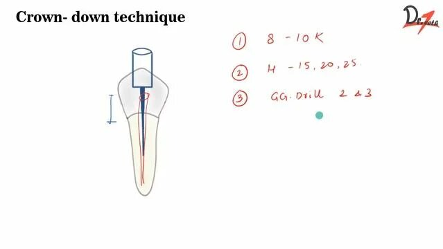 Crown- down Technique| Endodontics - Смотреть онлайн в поиске Яндекса ...