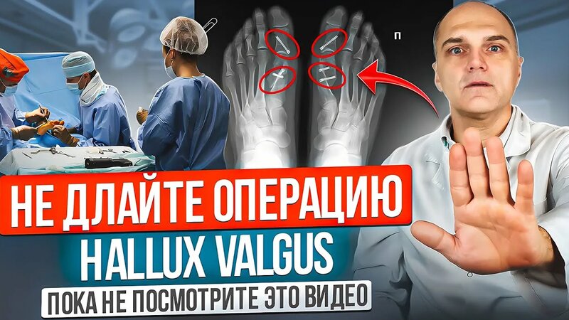 Hallux Valgus чего боятся пациенты перед операцией. Как восстновиться ...