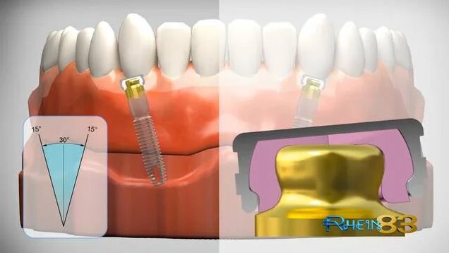 Принцип работы системы аттачментов Equator на имплантатах MIS ...
