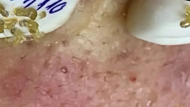 Loan Nguyen Acne Treatment 1435mh - Смотреть онлайн в поиске Яндекса по ...