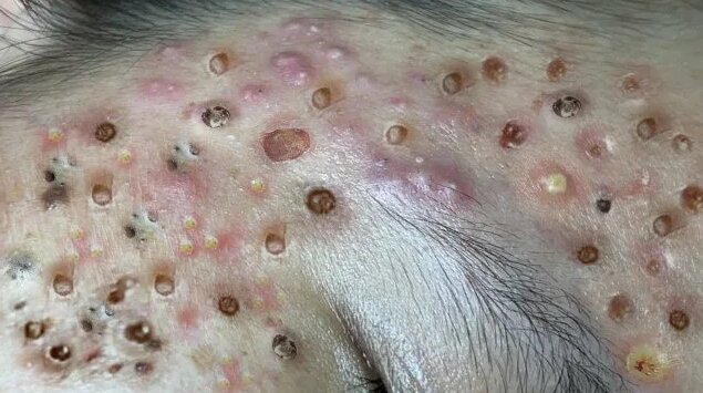 Loan Nguyen Acne Treatment 13877 - Смотреть онлайн в поиске Яндекса по ...