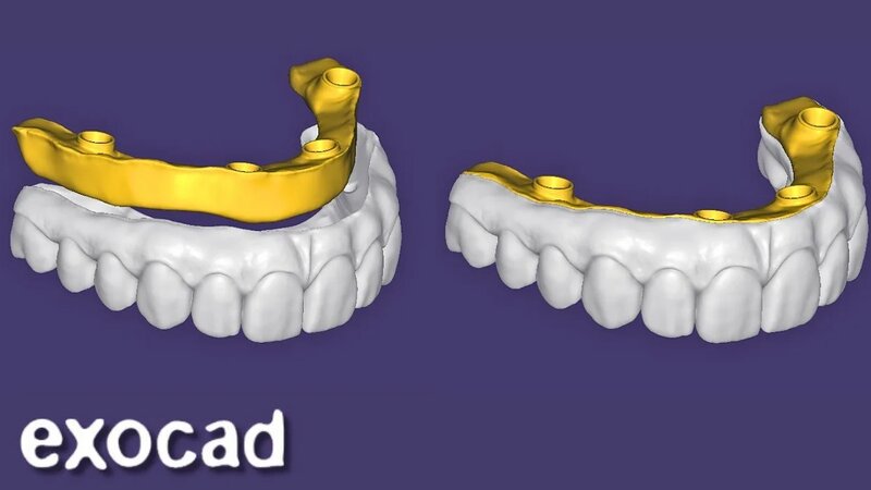 Design Blender Like BARS in Exocad - Yandex Video aramada çevrimiçi izle