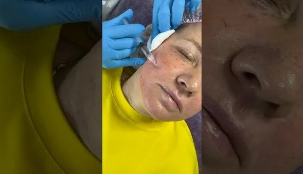 Мастер-класс: iFiller Nucleo 20 в практике косметолога ?#iFillerNucleo ...