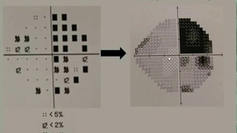 Visual Field Testing - Static versus Kinetic Perimetry - Смотреть ...