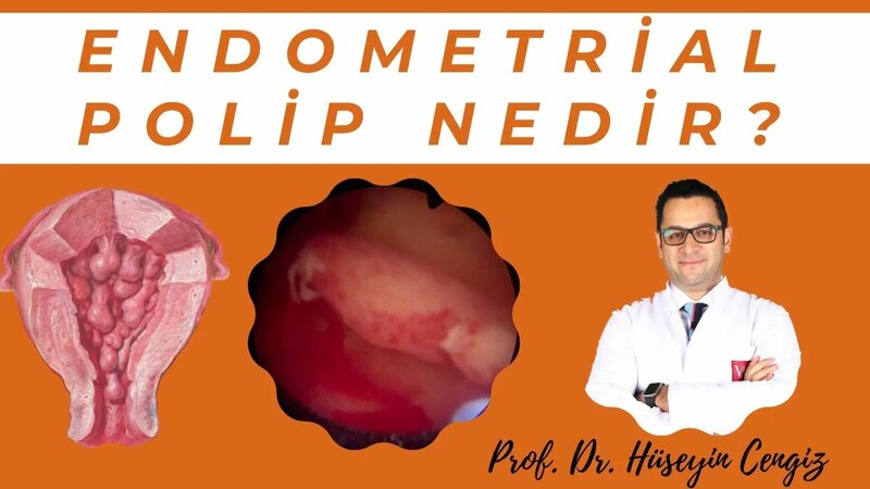 Endometrial Polip Nedir?(Rahim içi polip ve tedavisi) - Смотреть онлайн ...