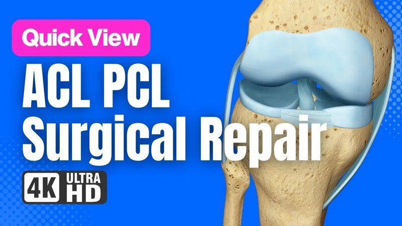 ACL PCL Surgical Reconstruction // See How It Works // 3D Animation ...