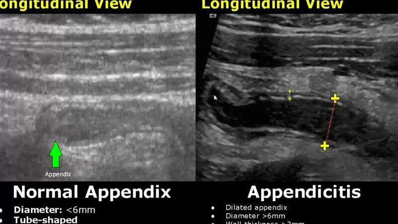 Appendix Ultrasound Normal Vs Abnormal Image Appearances | Appendicitis ...
