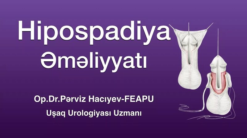 Hipospadiya Əməliyyatı - Thiersch Duplay Uretroplastikası - Yandex ...