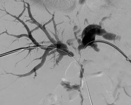 Percutaneous Transhepatic Cholangiography and Drainage (PTCD) - Yandex ...