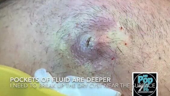 Видео Large inflamed cyst I D medical procedure Large cyst pop Cyst ...