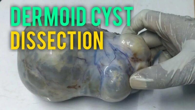 Big Size - Dermoid Ovarian Cyst (Teratoma) Dissection in Histopathology ...