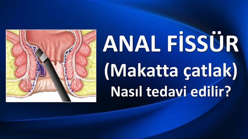 ANAL Fissür Makatta Çatlak - Смотреть онлайн в поиске Яндекса по Видео