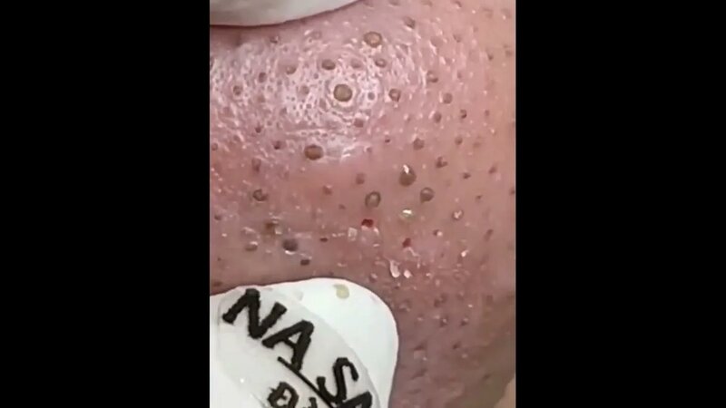 ASMR Satisfying extreme Blackhead Removal Animation/ Blackhead ...