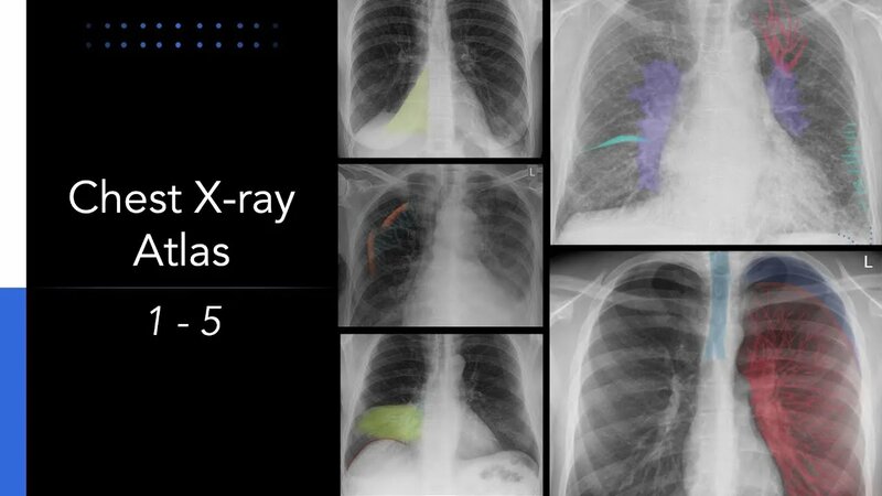 Chest X-ray Atlas: 5 Essential Chest X-rays for Students - Yandex Video ...