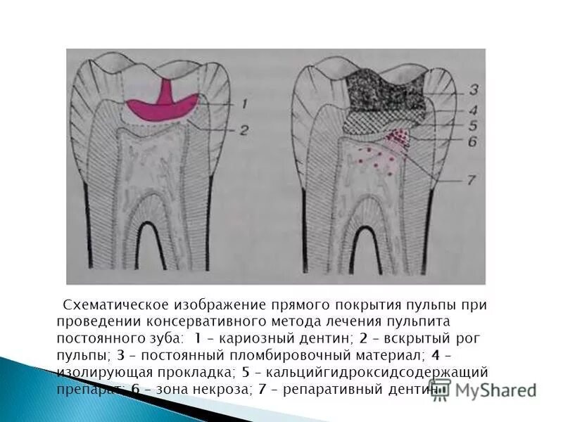 Материалы для покрытия пульпы – Telegraph
